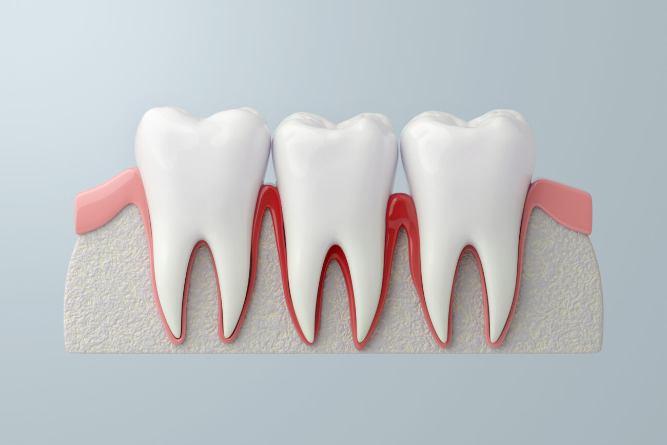 Gum Disease and Diabetes: Understanding the Connection